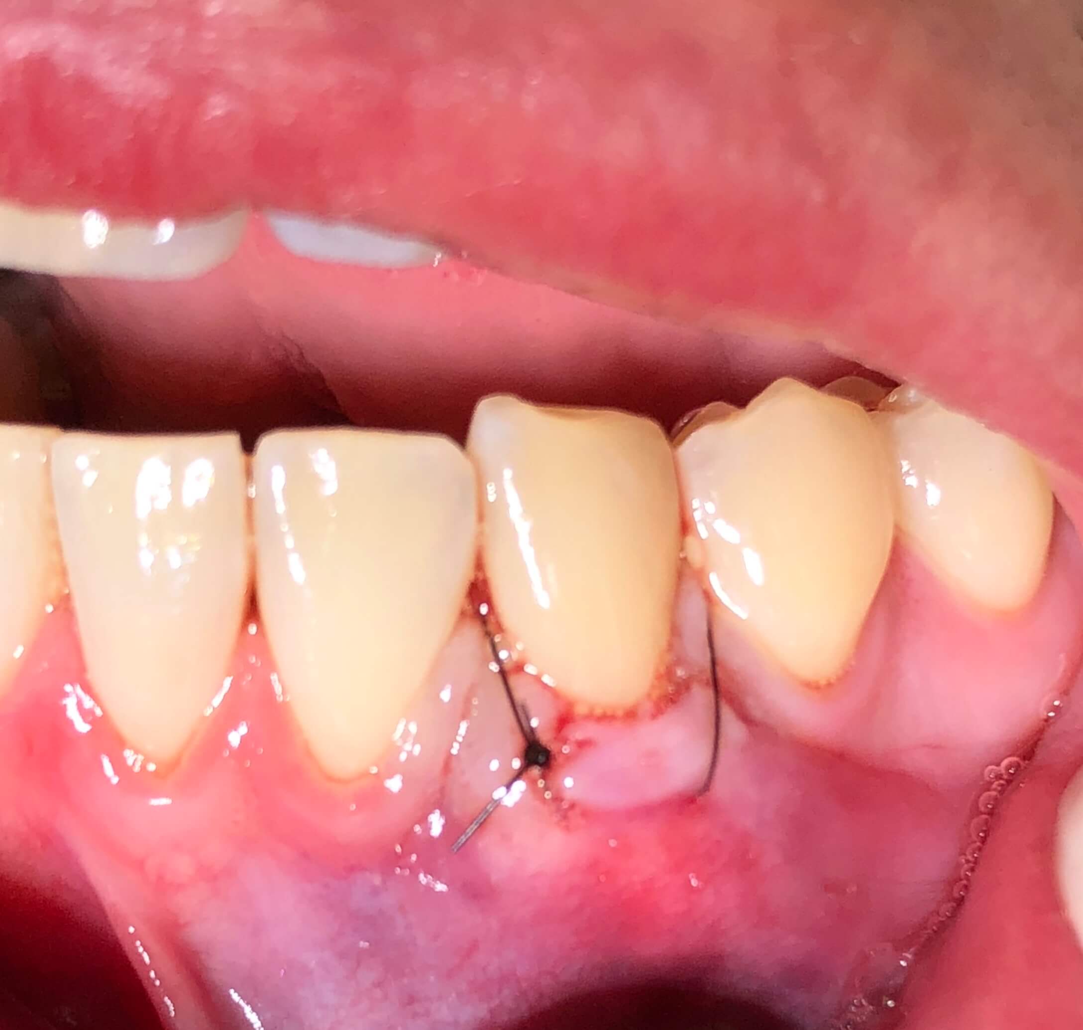 Oral Surgery - U-Dental Clinic